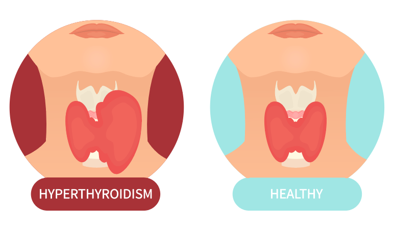 Hyperthyroidism
